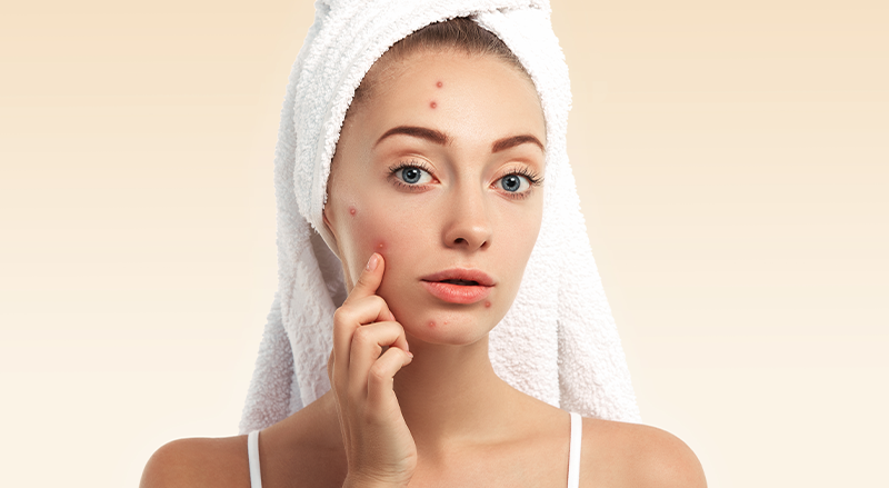 7 Easy Tips to Avoid Pimples | Dazzling Beauty Salon